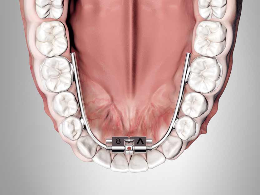Tornillos de expansión especiales - DENTAURUM